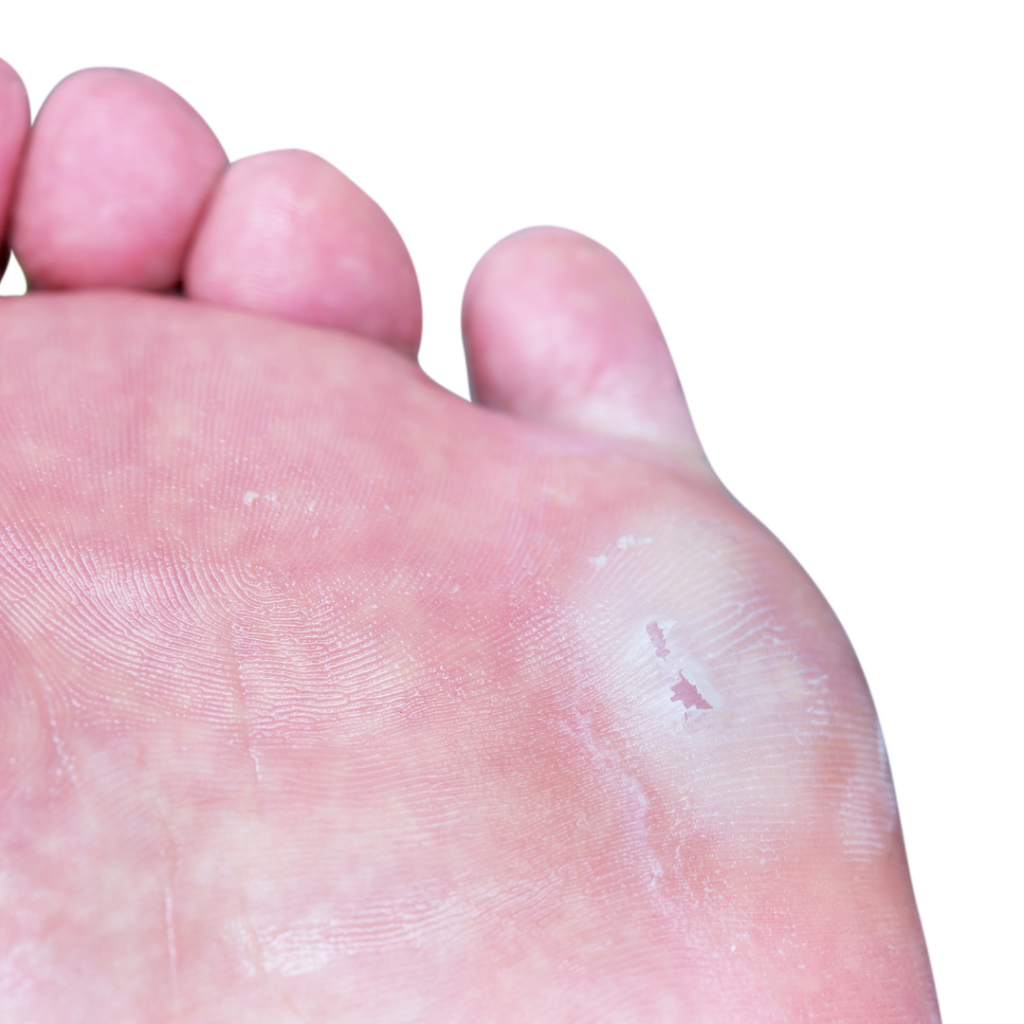 Corns: The Uncomfortable Formation – American Foot & Leg Specialists